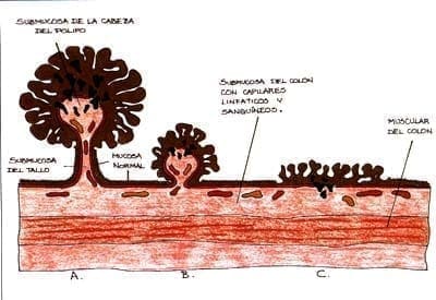 RESECCIÓN DE PÓLIPOS PEDICULADOS Y SEUDOPEDICULADOS, MEDICINA